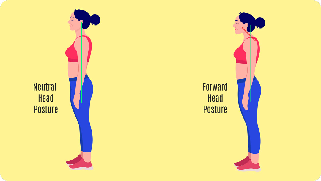 Forward Head Posture - How to Correct and Improve Neck Alignment
